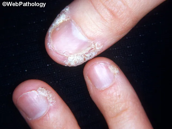 Fingernail Warts Periungual Warts | SpringerLink