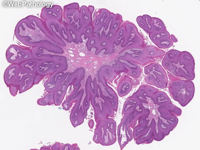 Condyloma Acuminata : Microscopic
