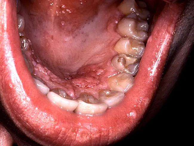 hpv throat
