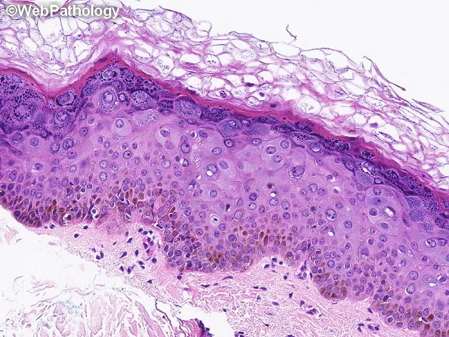 Epidermodysplasia Verruciformis Histology Sebaceous Cell Carcinoma