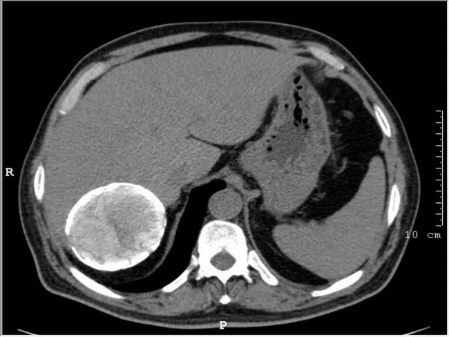 Calcified Hydatid Cyst - Liver : CT Scan