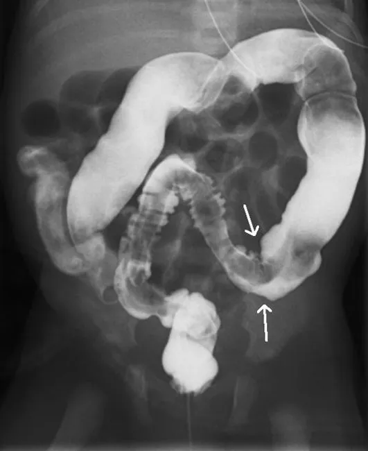 Hirschsprung Disease : Barium enema