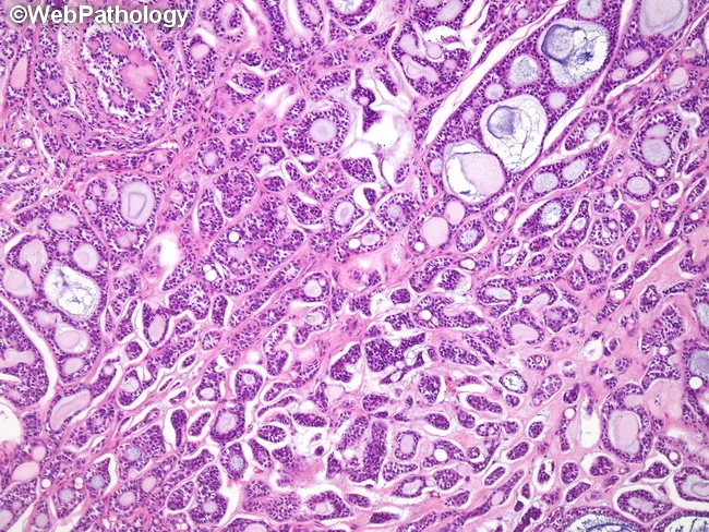 Adenoid Cystic CA : Molecular Pathogenesis