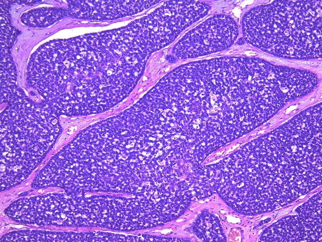 Adenoid Cystic CA : Solid Pattern