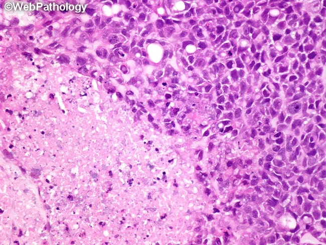 Adenoid Cystic CA : Solid Pattern