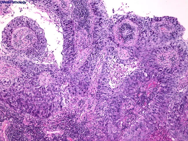 Transitional (Cylindrical) Cell Carcinoma in Sinonasal Papilloma