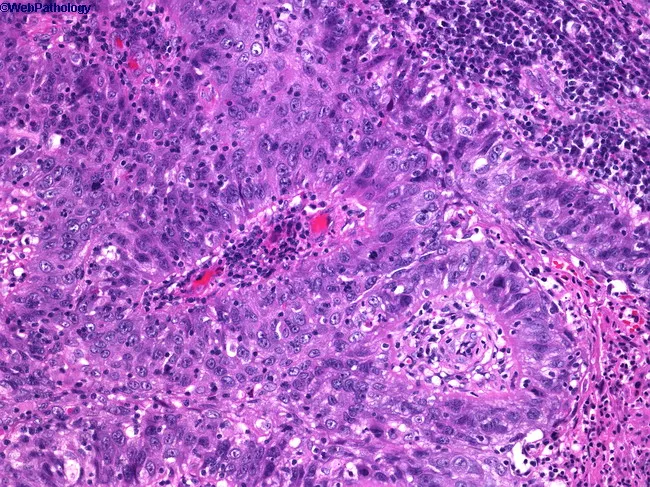 Transitional (Cylindrical) Cell Carcinoma in Sinonasal Papilloma