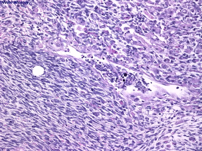 Embryonal Rhabdomyosarcoma - Nasal Cavity