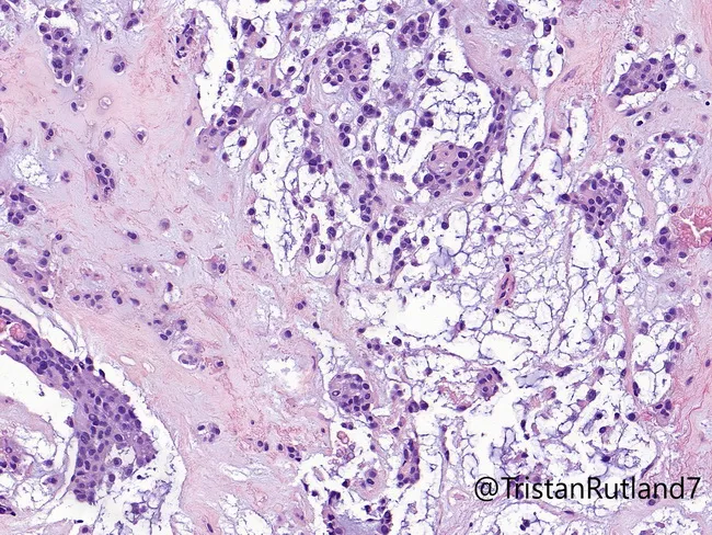 Ceruminous Pleomorphic Adenoma