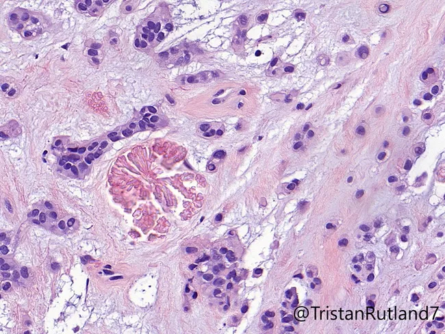 Ceruminous Pleomorphic Adenoma