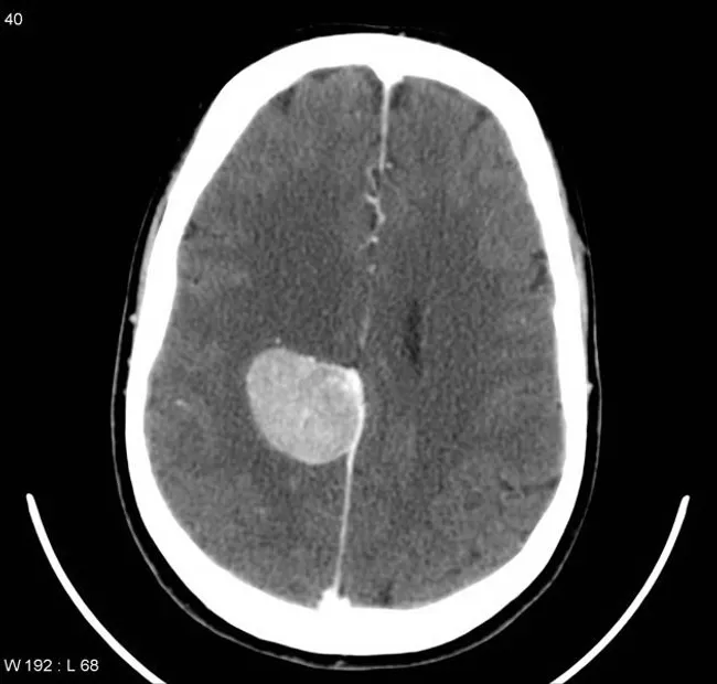 Meningioma - Radiographic Features