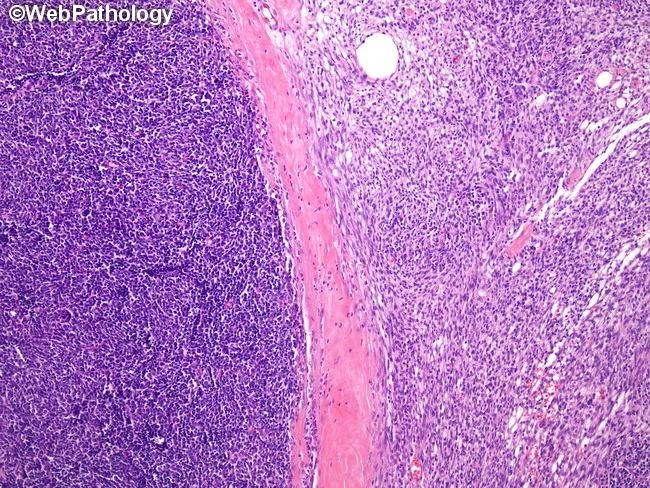 Type AB Thymoma : Microscopic