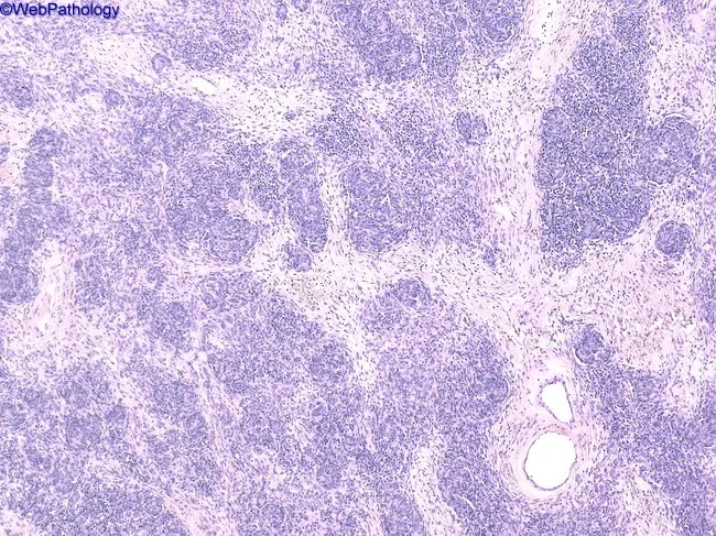 Type AB Thymoma