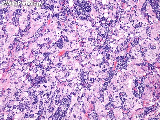 Type B2 Thymoma : Differential