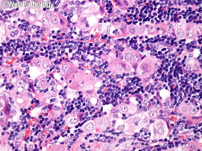 Type B2 Thymoma : Treatment & Prognosis
