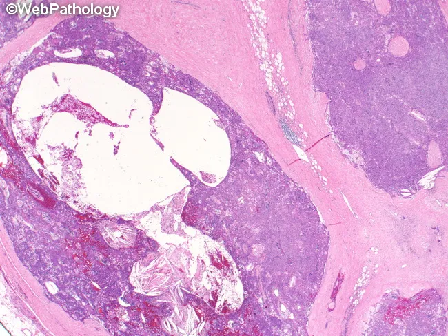 Type B3 Thymoma : Definition