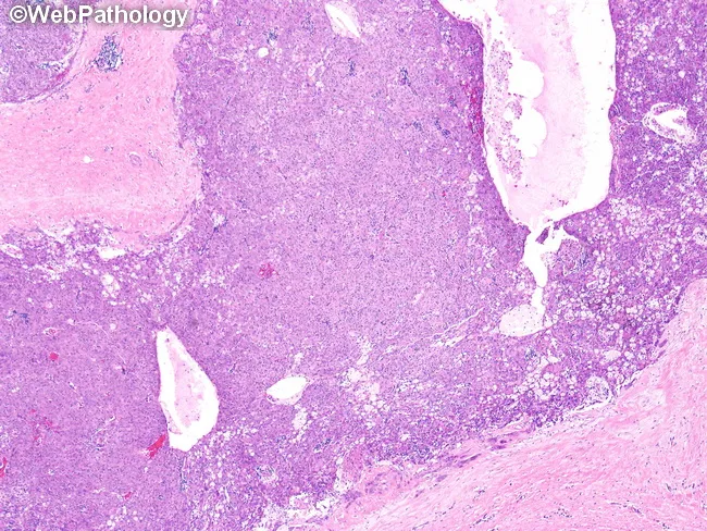 Type B3 Thymoma : Presentation