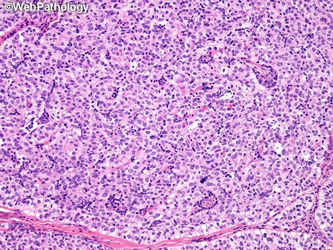 Type B3 Thymoma : Microscopic