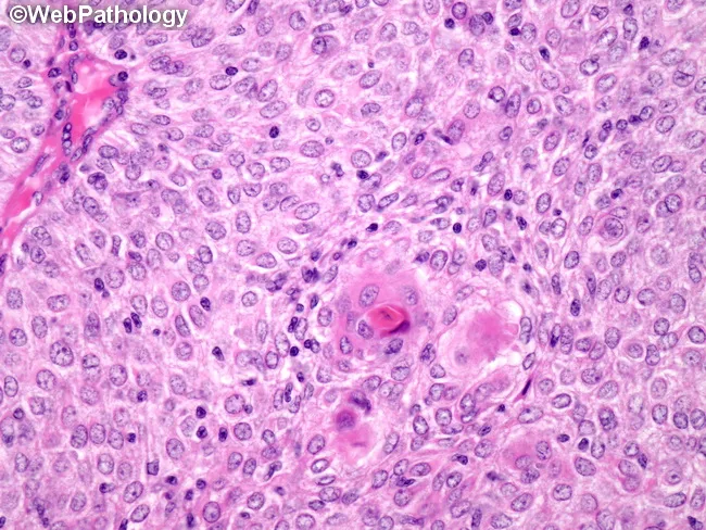 Type B3 Thymoma : Immunostains