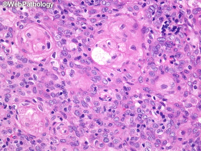 Type B3 Thymoma : Prognosis