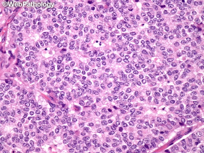 Carcinoid of Thymus : Gross Pathology