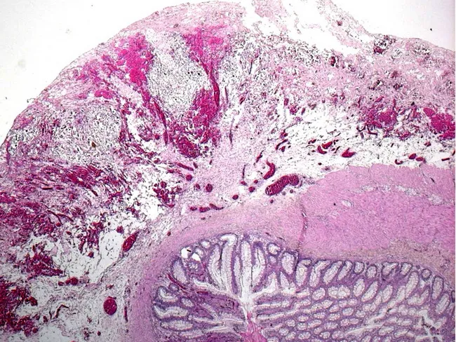 Meconium Peritonitis