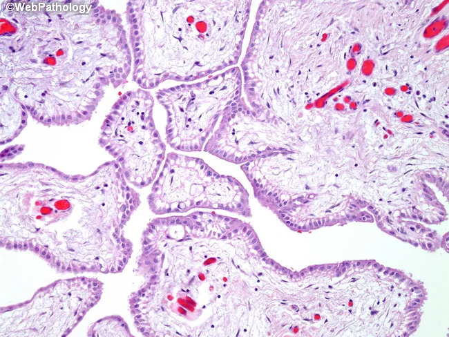 Mesothelial Hyperplasia in a Hernia Sac