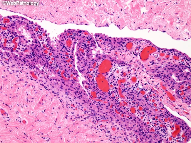 Mesothelial Hyperplasia in a Hydrocele