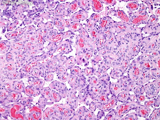 what is mesothelial hyperplasia