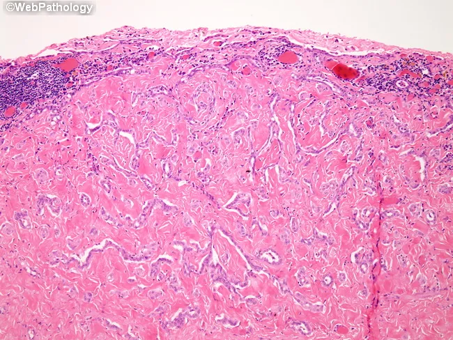 Mesothelial Hyperplasia in a Hydrocele