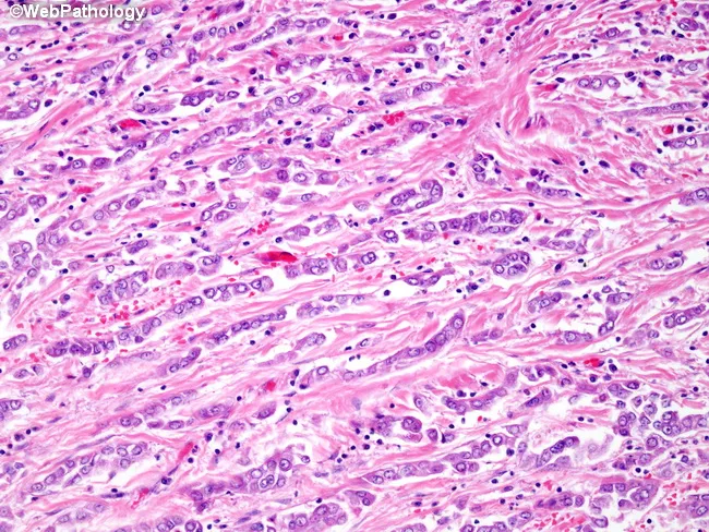 Malignant Mesothelioma