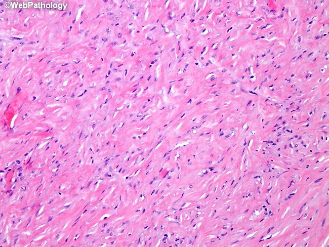 mesothelioma histology pathology outlines