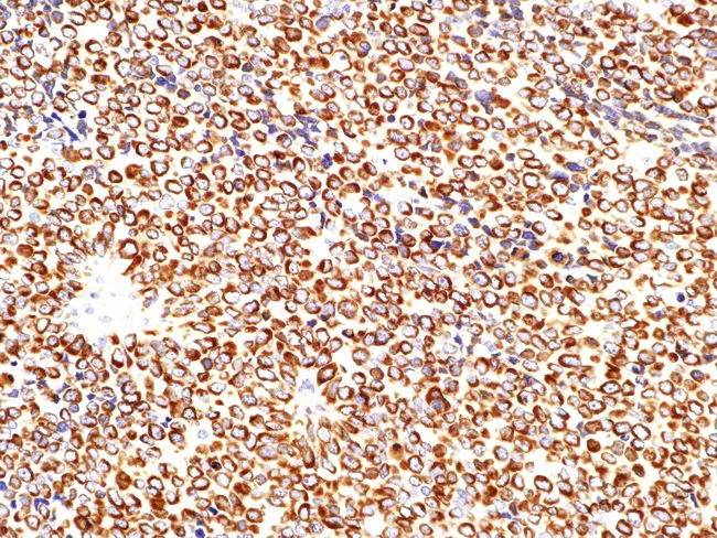 Desmoplastic Small Round Cell Tumor : WT1