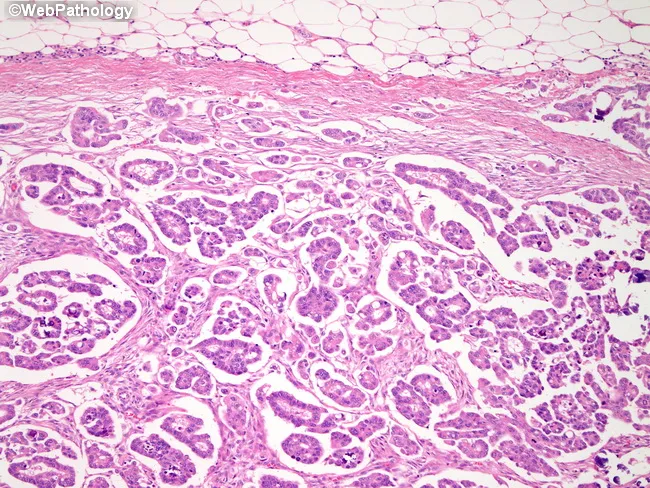 High-grade Serous Papillary Carcinoma of Ovary