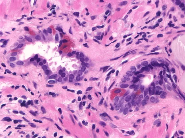 Neuroendocrine Cells in Atrophic Prostate Glands