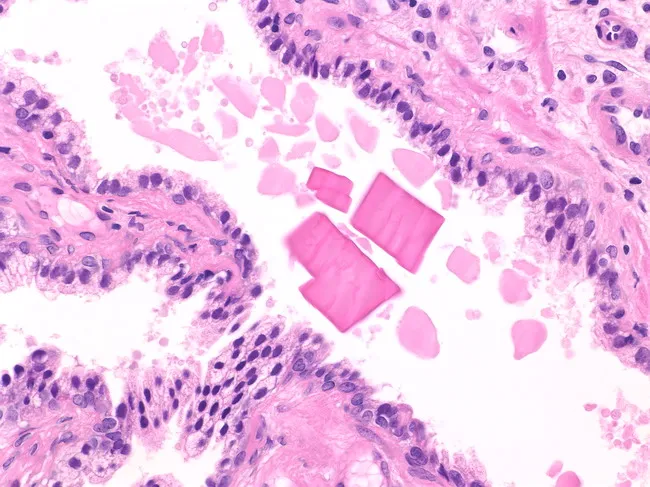 Prostate - Crystalloids in Benign Glands