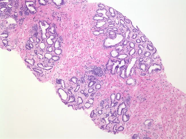 Lobular Atrophy in Prostate