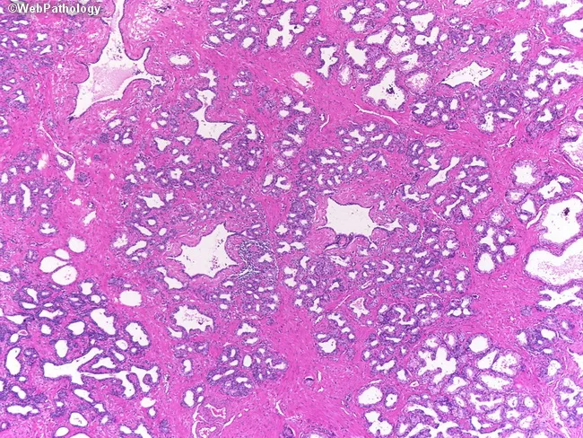 Post-atrophic Hyperplasia