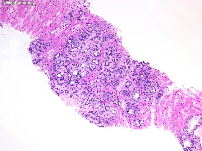 Post-atrophic Hyperplasia