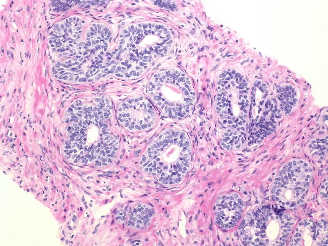 Basal Cell Hyperplasia in Prostate Needle Biopsy