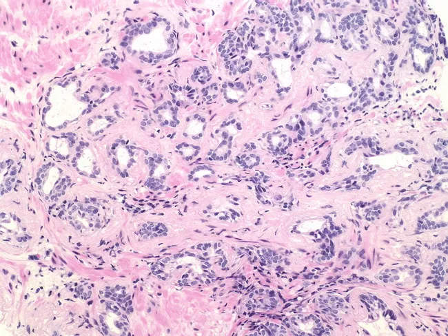 Post-atrophic Hyperplasia