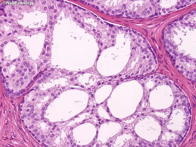 Clear Cell Cribriform Hyperplasia