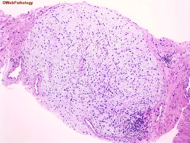 Prostate : Stromal Hyperplasia