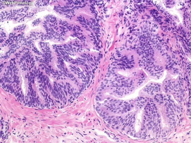 High-grade PIN : Clinical Significance