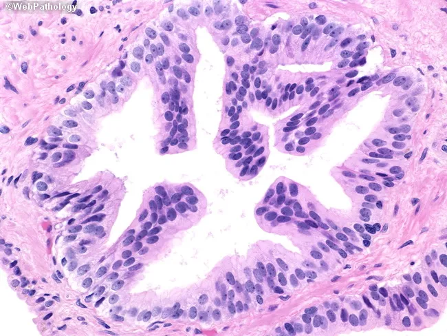 High-grade PIN : Tufting type