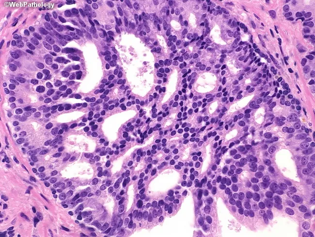 High-grade PIN : Cribriform type