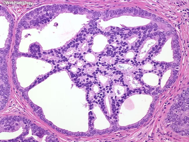 High-grade PIN : Cribriform type