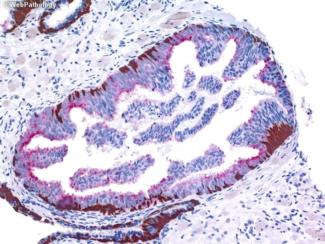 High-grade PIN : Triple Stain