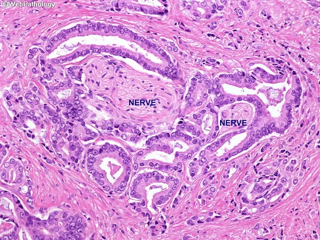 Adenocarcinoma of Prostate : Perineural Invasion