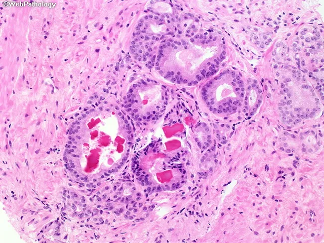 Adenocarcinoma of Prostate : Crystalloids